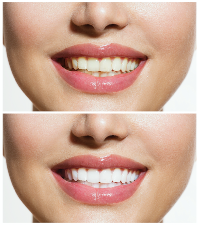 Benefits of Healthy Professional Teeth Whitening Treatments