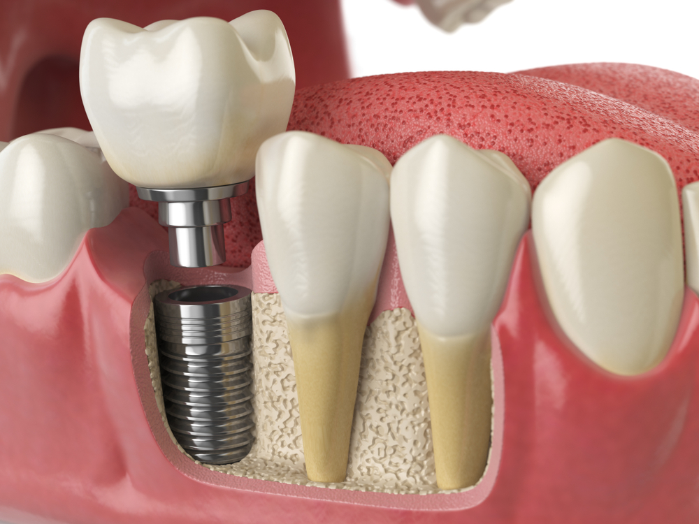 How to Prevent Bone Loss after Tooth Extraction
