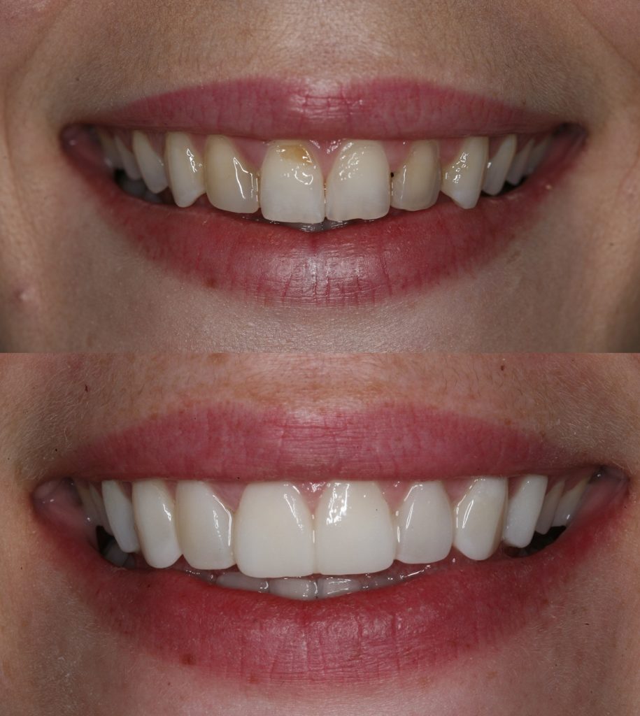 Trial Smiles: A Way to Try On Veneers Before You Commit