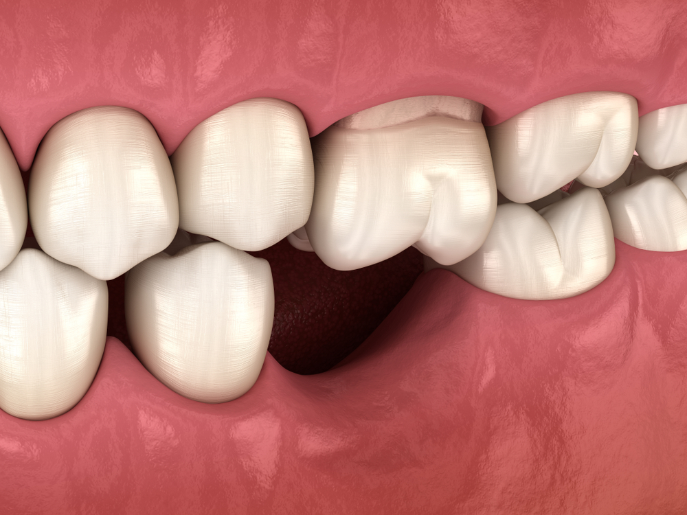 Consequences Of Missing Teeth Consequences Of Missing Teeth