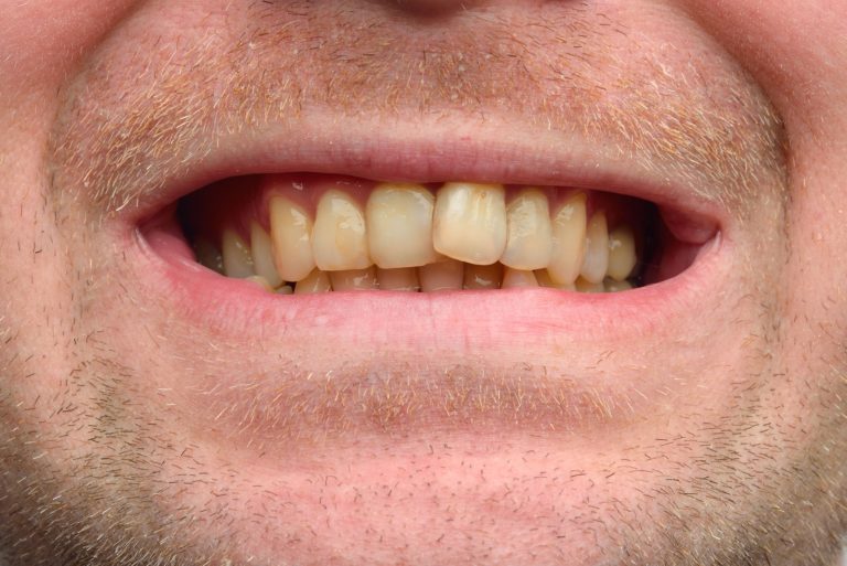 What Causes Yellow Teeth?