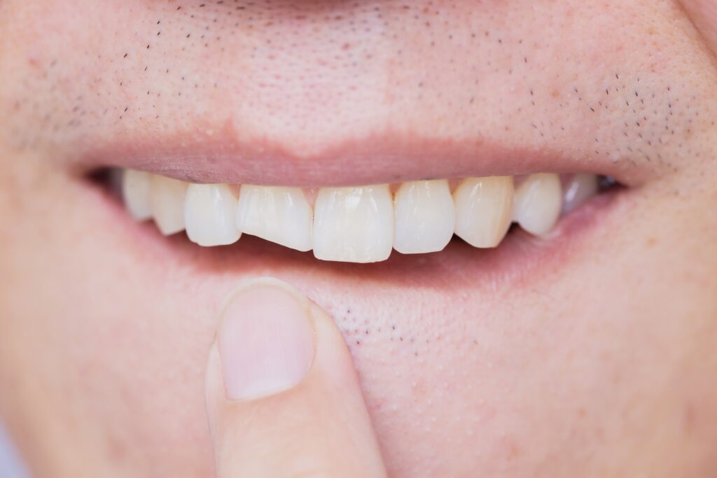 How to Fix a Chipped Tooth