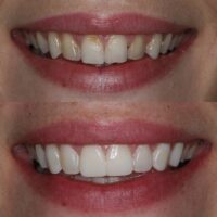 Trial Smile: The Try-Before-You-Buy Option for Cosmetic Dentistry