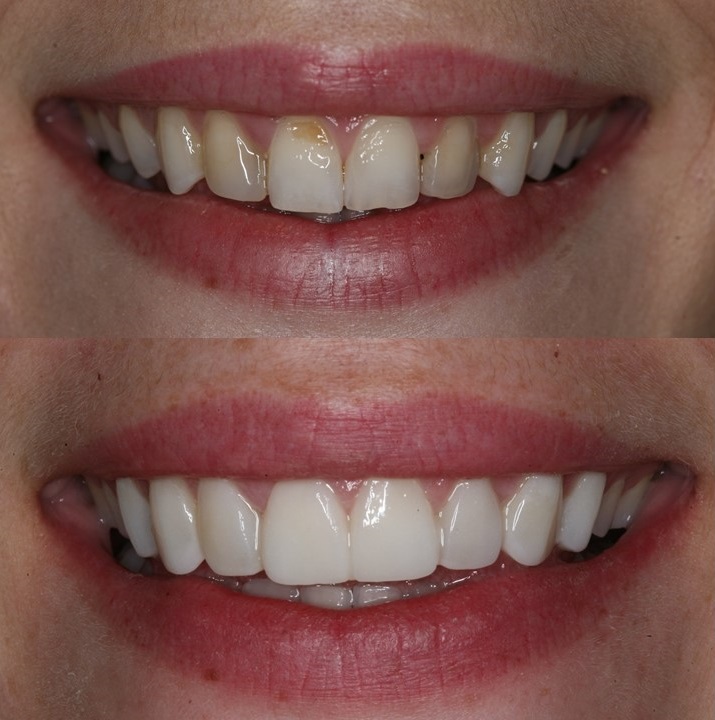 Trial Smile: The Try-Before-You-Buy Option for Cosmetic Dentistry