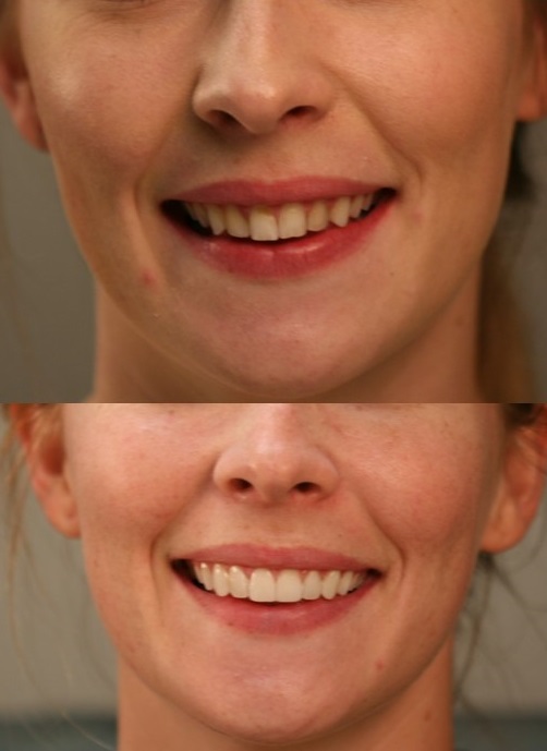 Trial Smile: The Try-Before-You-Buy Option for Cosmetic Dentistry