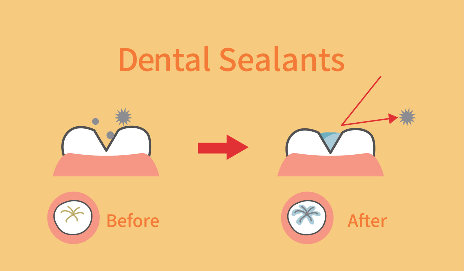 Sealants: They’re Not Just for Kids!