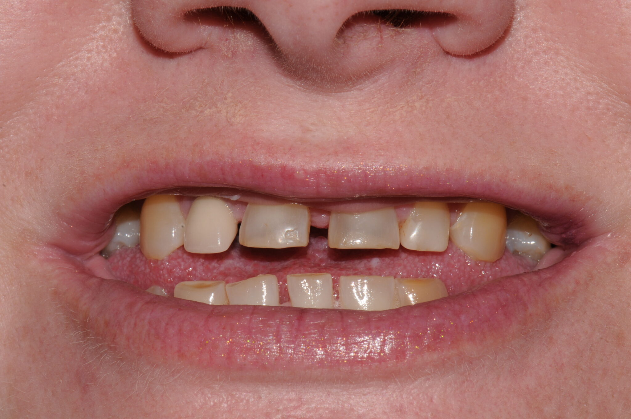 Why Do My Teeth Look So Short?