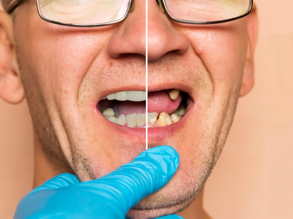 What are the Best Ways to Replace Multiple Missing Teeth?